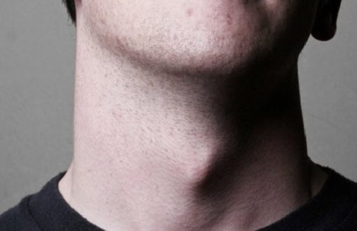 Edema de Reinke | Centro de Terapia del Lenguaje